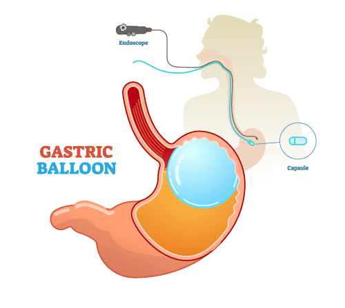 Gastric Balloon | Dubai Gastroenterology Clinic